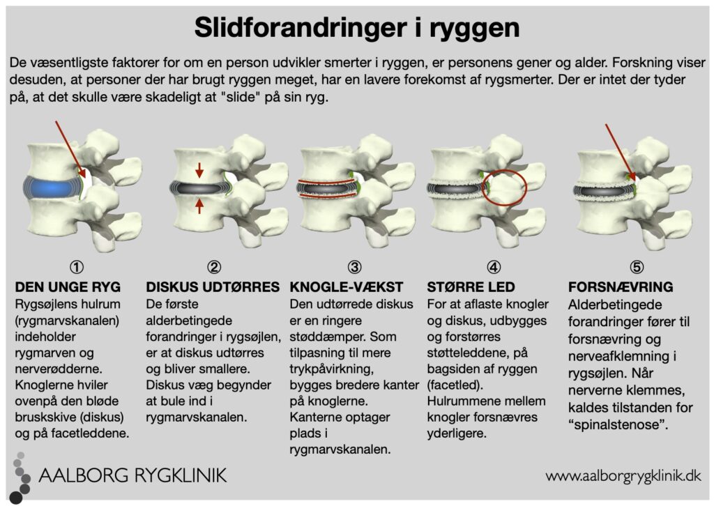 slidgigt i ryggen